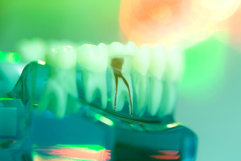 Ενδοδοντία - Papakostas Dental Services